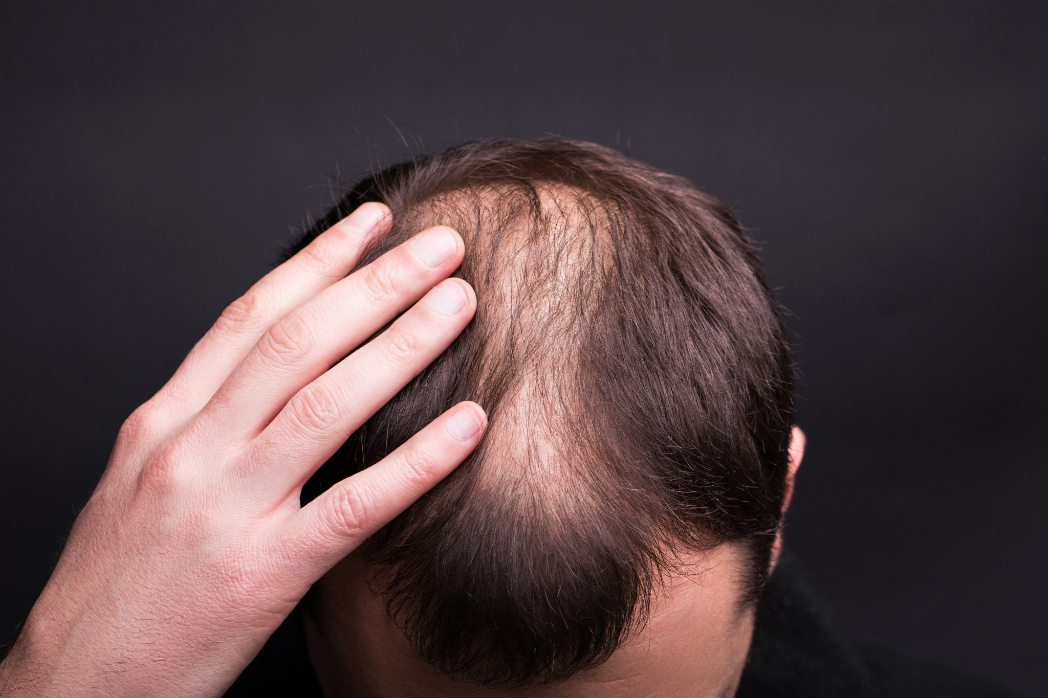 The Different Stages of Receding Hairline - estheteclinic.com